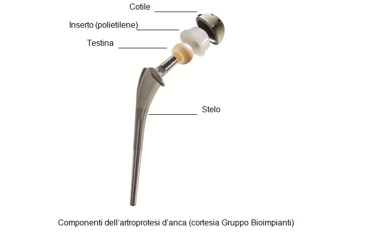 Artroprotesi anca | Patologieortopediche.com - dott. Fabrizio Rivera ...
