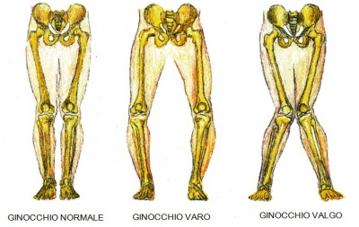 Ginocchio varo e valgo | Patologieortopediche.com - dott. Fabrizio ...